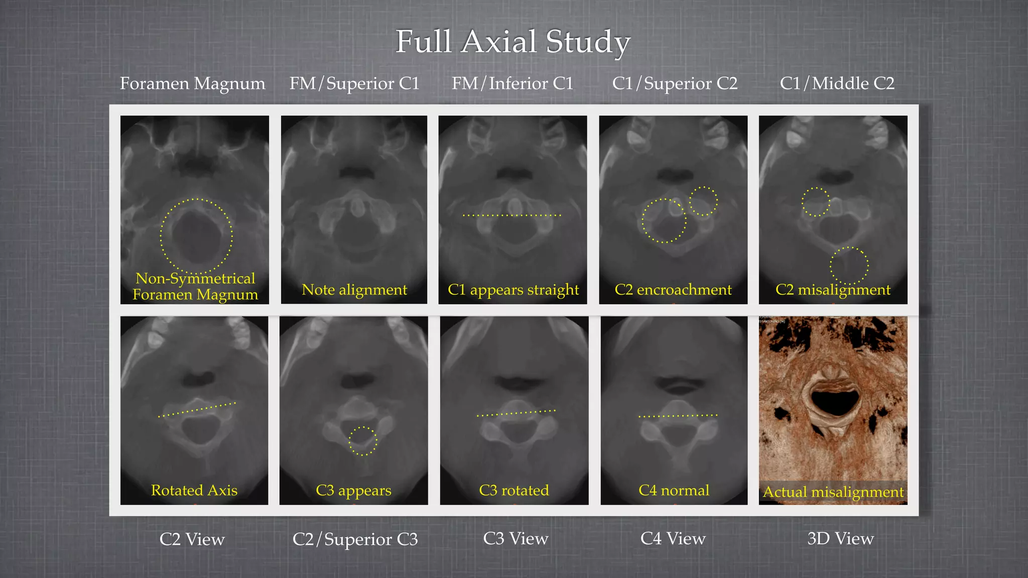 Upper Cervical Cone Beam 3D Preview | PDF