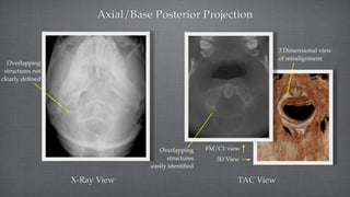 Upper Cervical Cone Beam 3D Preview | PDF
