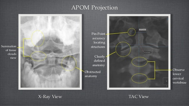 Upper Cervical Cone Beam 3D Preview