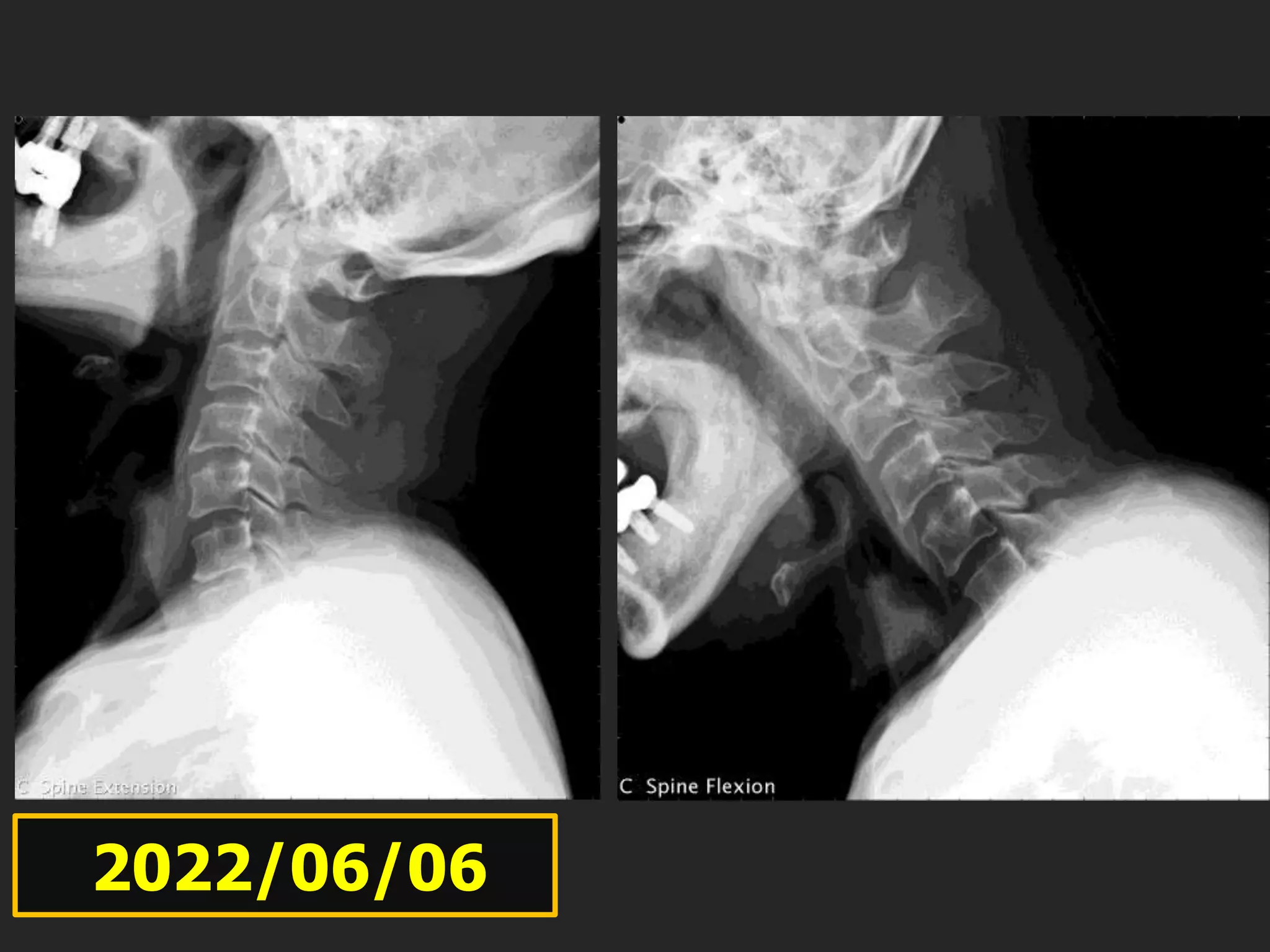 upper cervical trauma.pptx