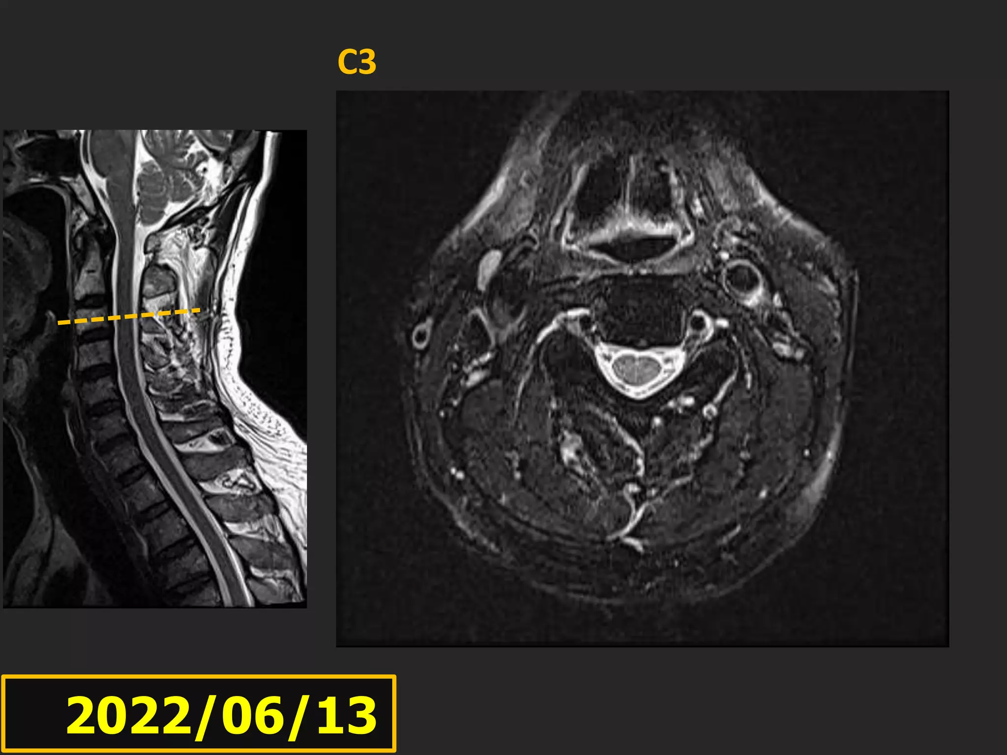 upper cervical trauma.pptx