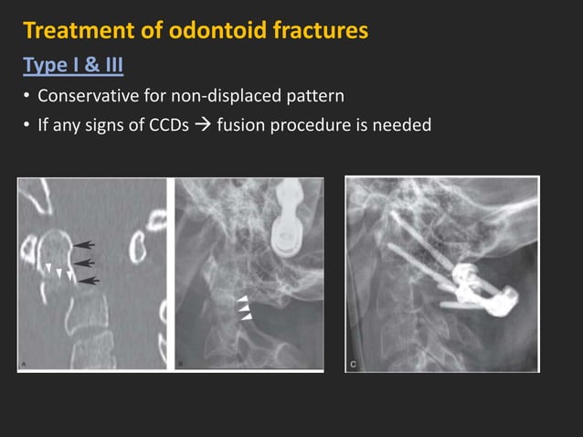 upper cervical trauma.pptx