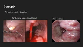 Upper GI endoscopy | PPTX