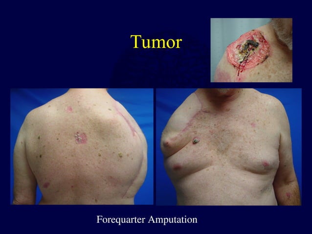 Upper Extrimity Upper Limb Amputation Ppt