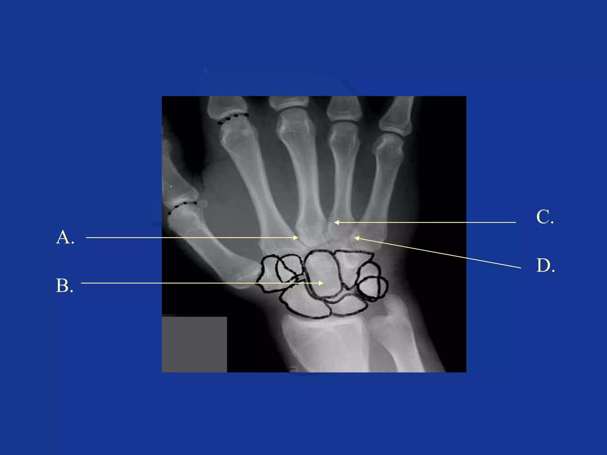 Upper extremity anatomy & positioning | PPT