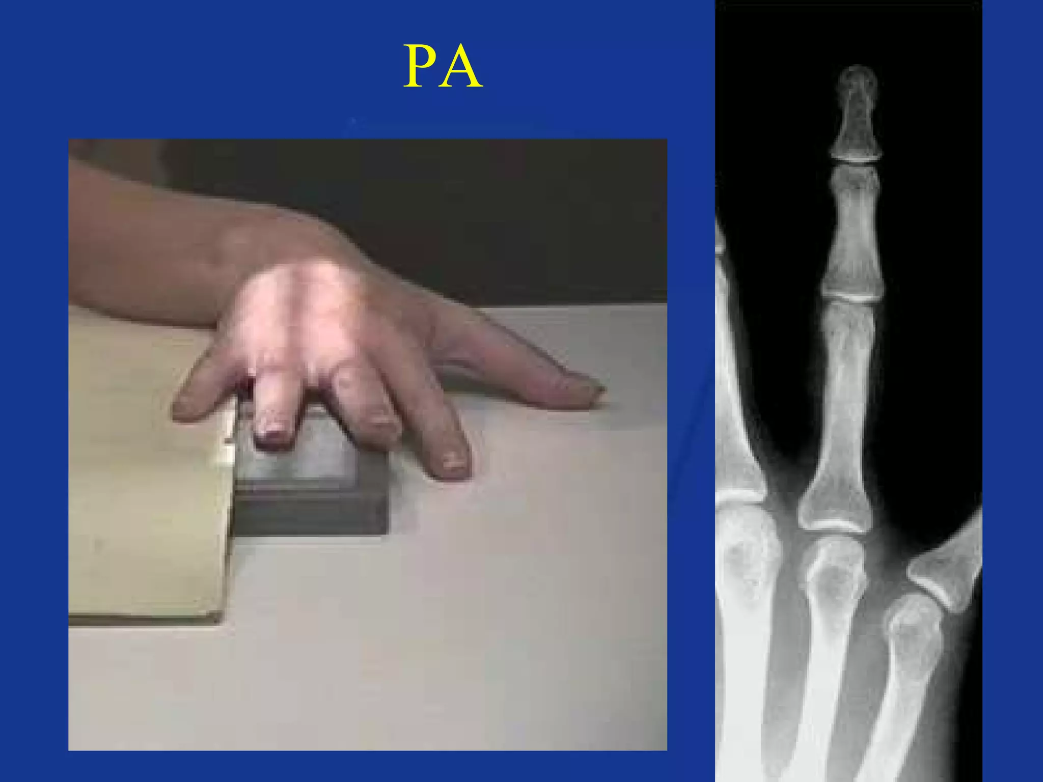 Upper extremity anatomy & positioning | PPT