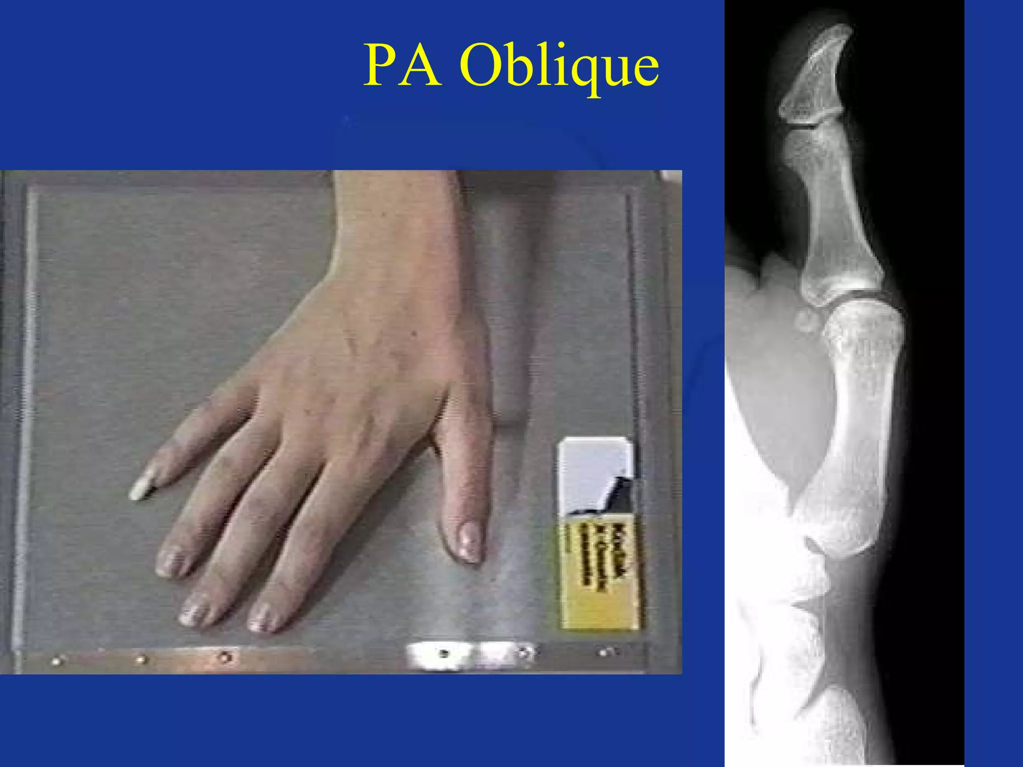 Upper extremity anatomy & positioning | PPT