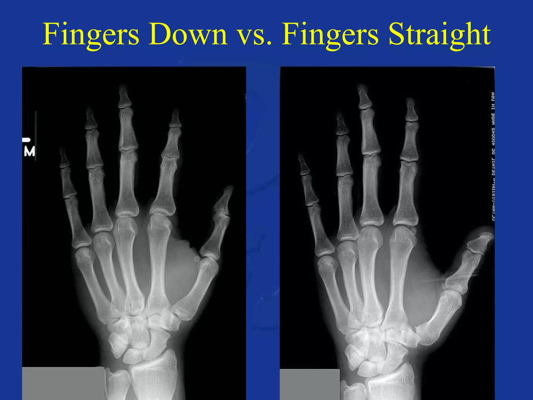 Upper extremity anatomy & positioning | PPT
