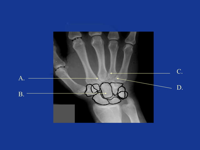 Upper extremity anatomy & positioning | PPT | Death, Injury, or ...