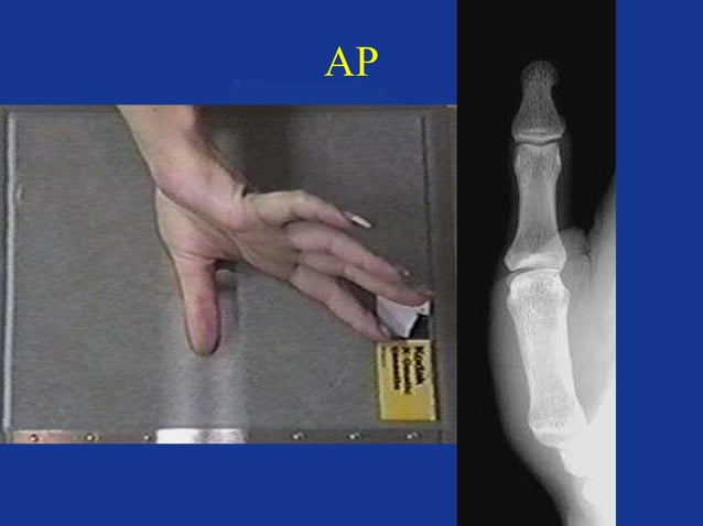 Upper extremity anatomy & positioning | PPT | Death, Injury, or ...