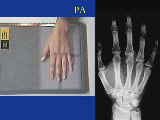 Upper extremity anatomy & positioning | PPT | Death, Injury, or ...