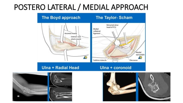 Upper extremity approach - Elbow surgery | PPT