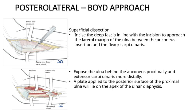 Upper extremity approach - Elbow surgery | PPT