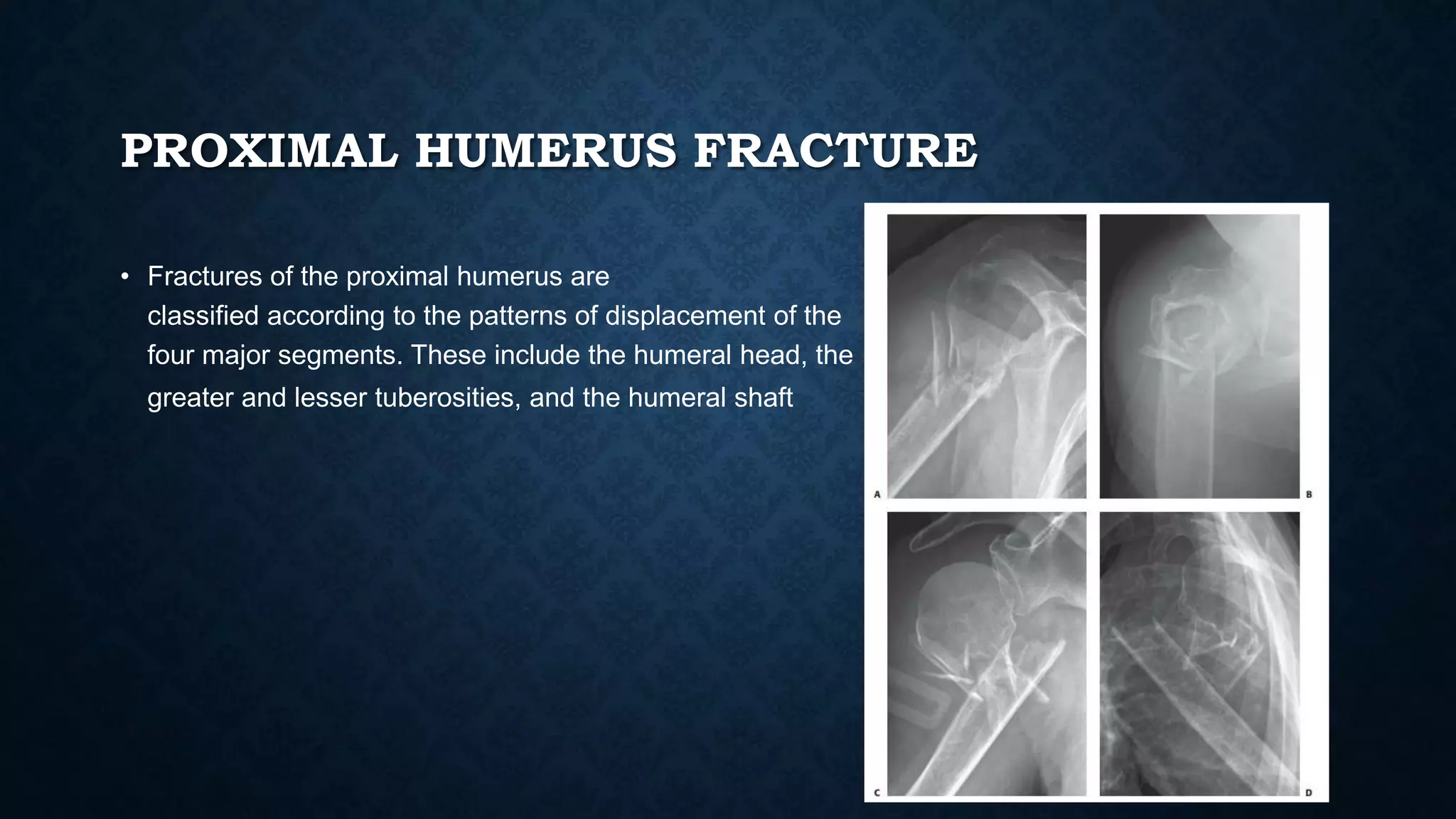 Upper extremity fracture principles | PPTX