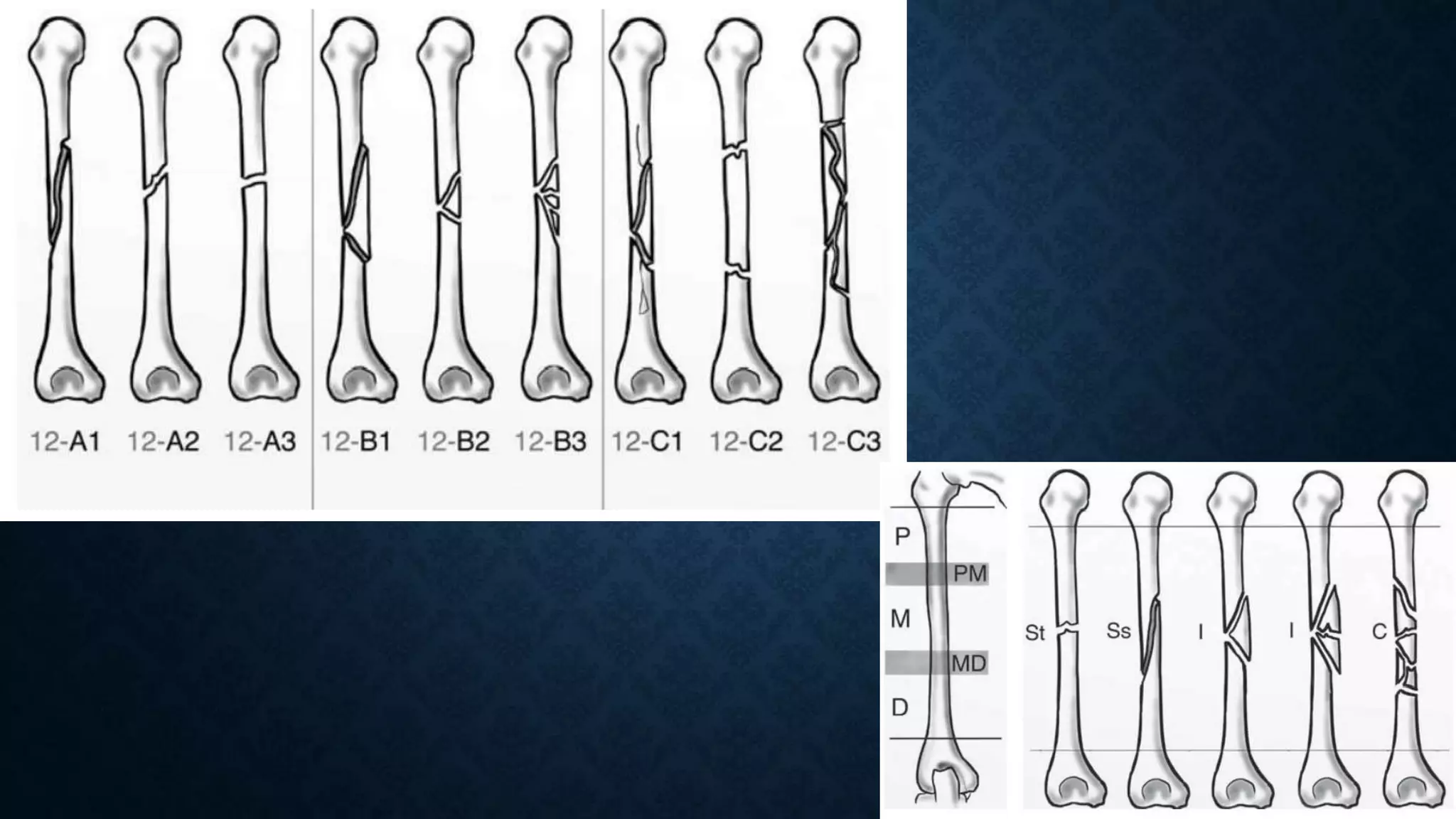 Upper extremity fracture principles | PPTX