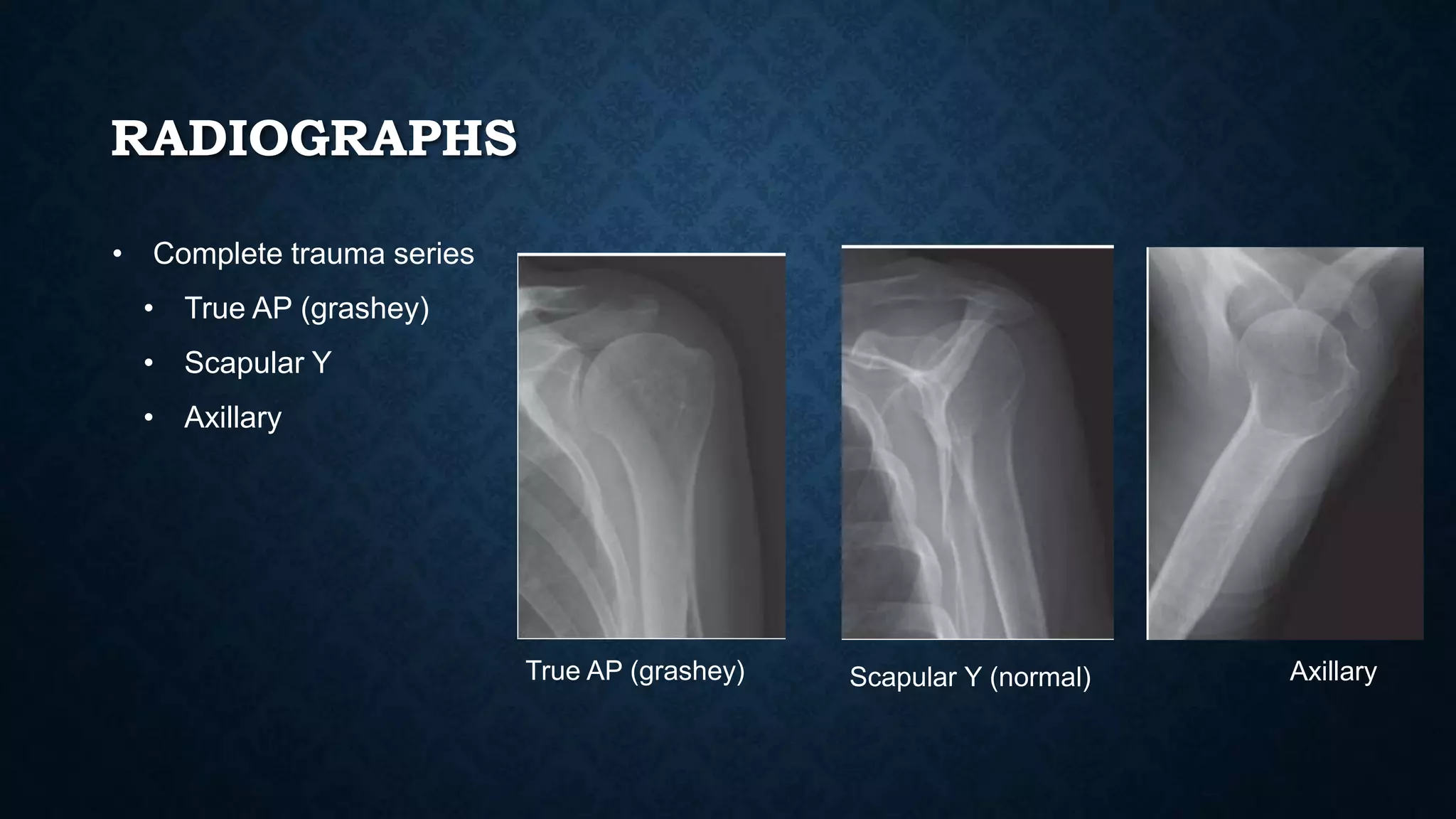Upper extremity fracture principles | PPTX