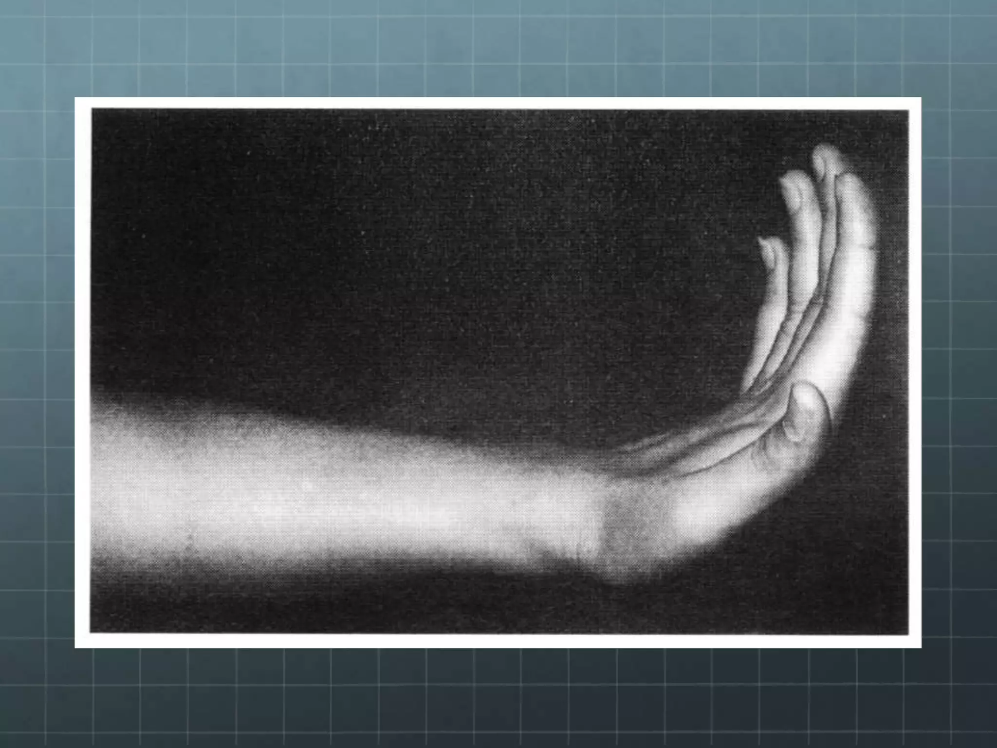 Upper extremity peripheral nerve injury | PPTX