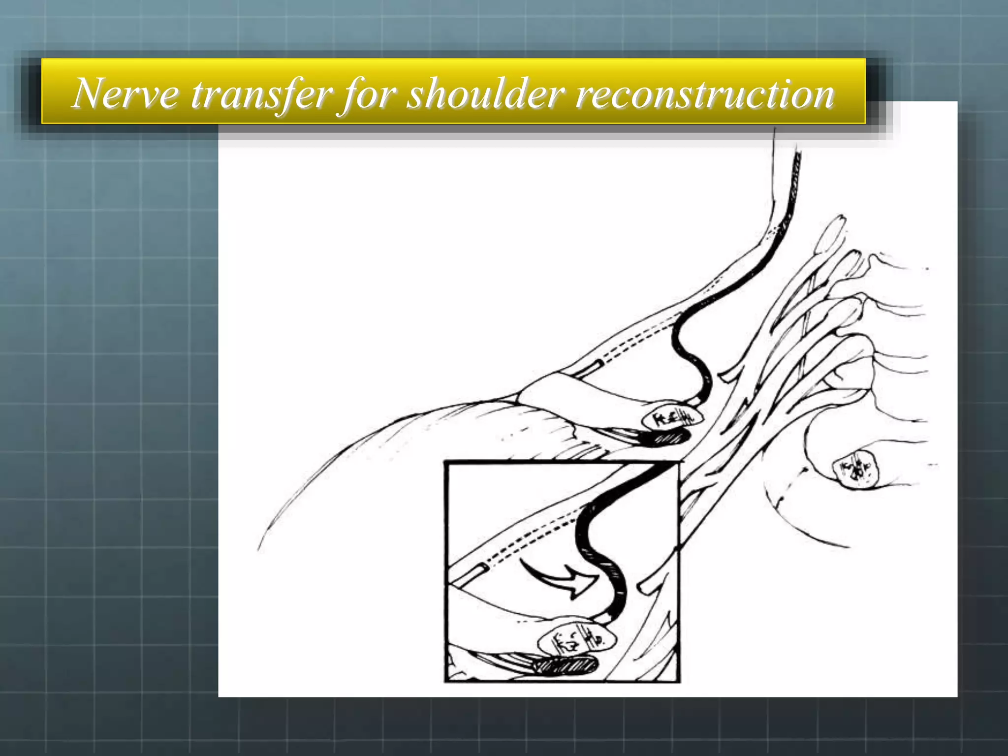 Upper extremity peripheral nerve injury | PPTX