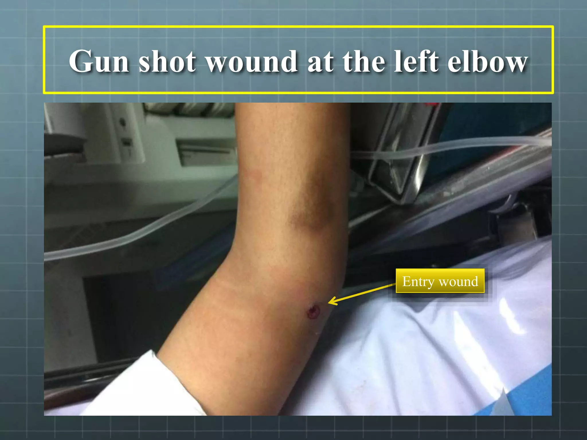 Upper extremity peripheral nerve injury | PPTX