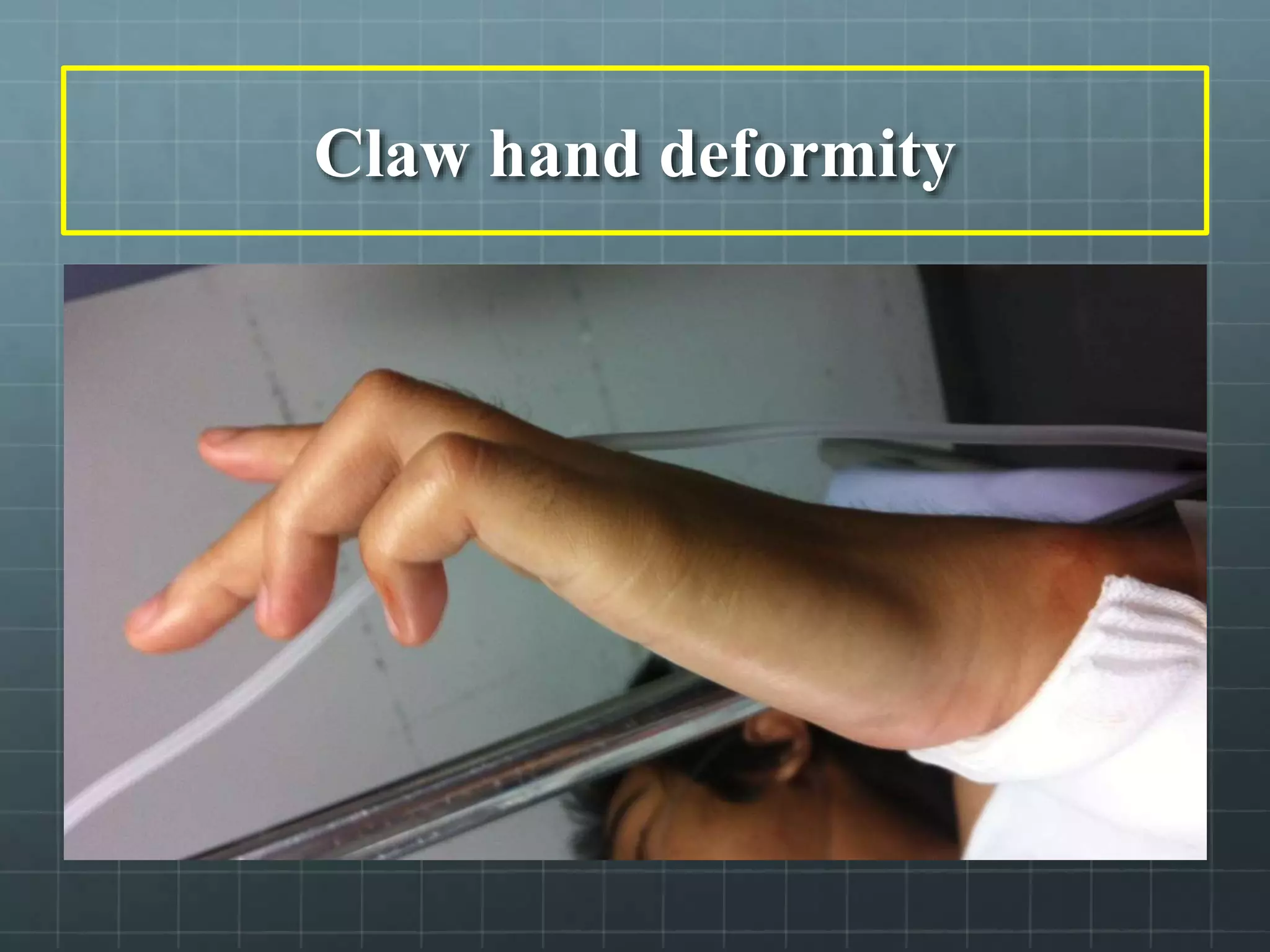 Upper extremity peripheral nerve injury | PPTX