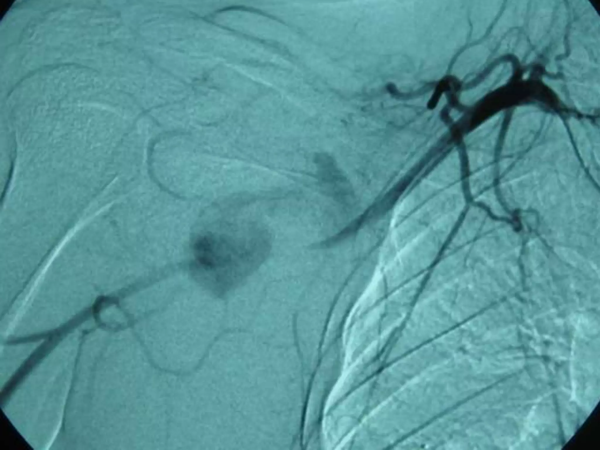 Upper extremity peripheral nerve injury | PPTX