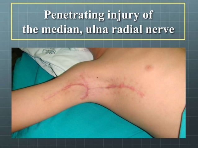 Upper extremity peripheral nerve injury | PPTX