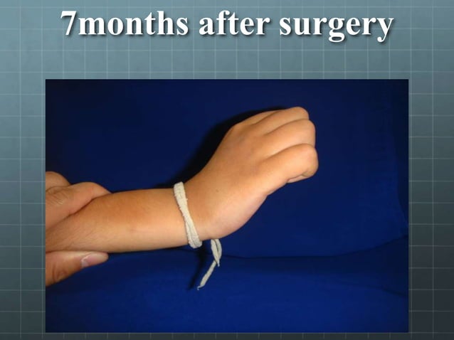 Upper extremity peripheral nerve injury | PPTX