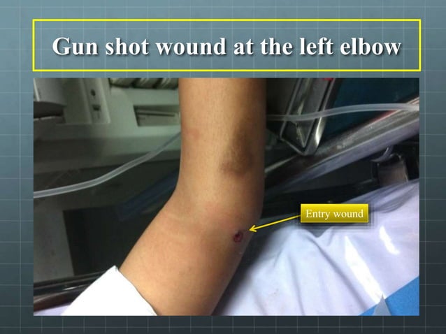 Upper extremity peripheral nerve injury | PPTX