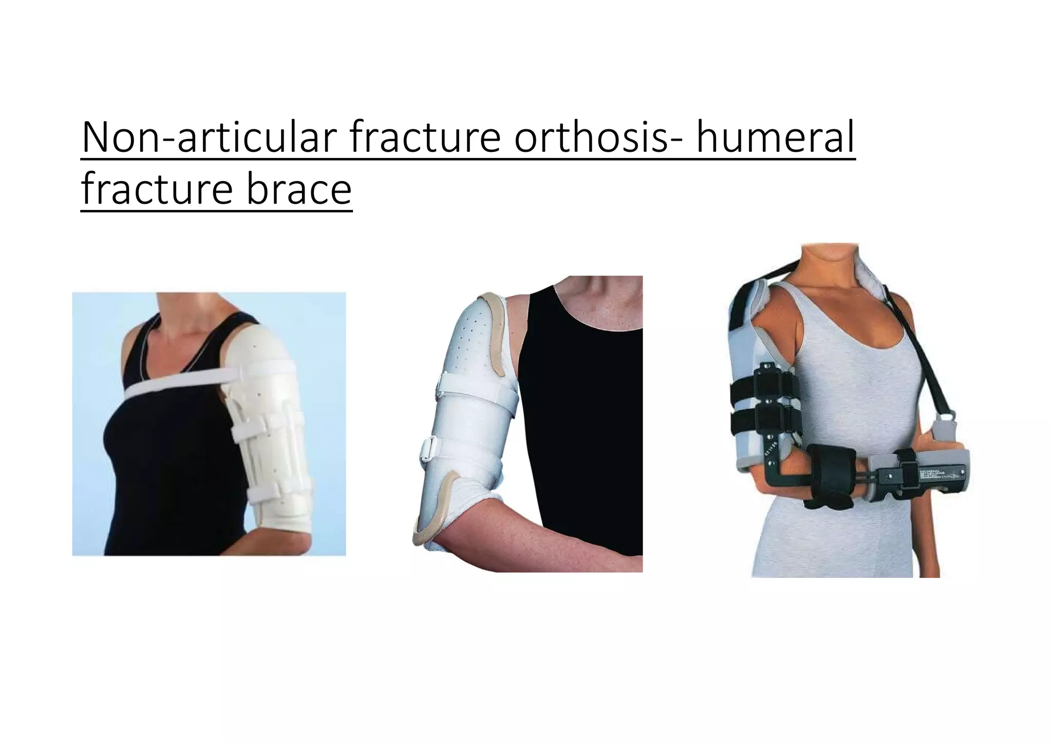 Upper extremity orthoses | PDF
