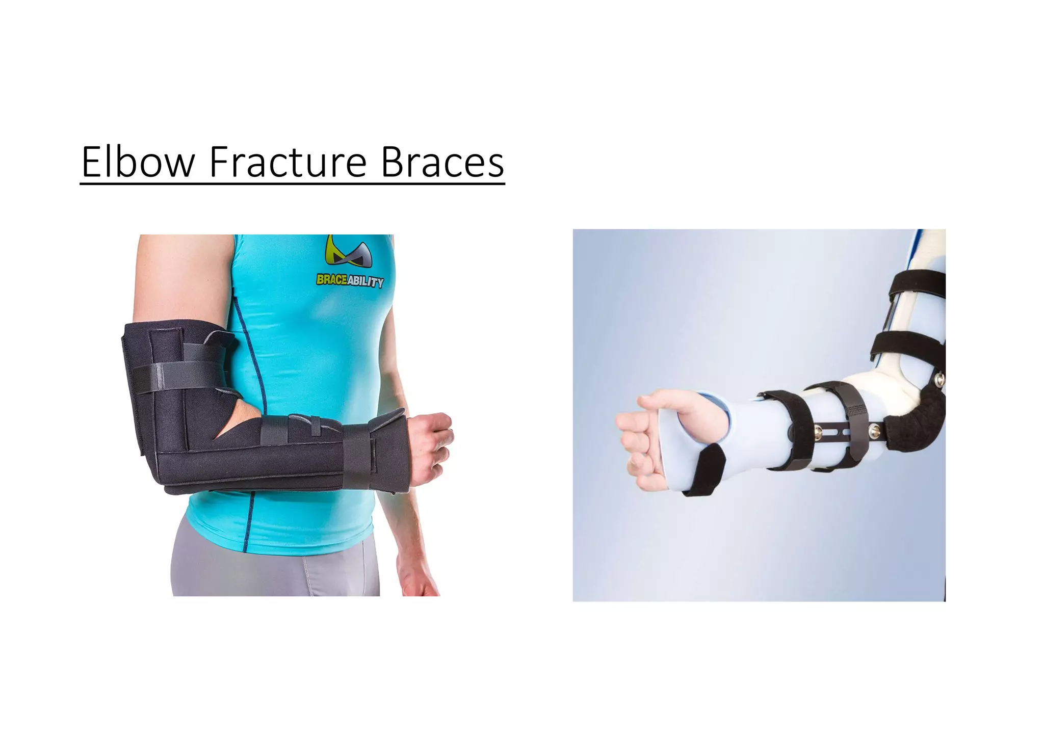 Upper extremity orthoses | PDF