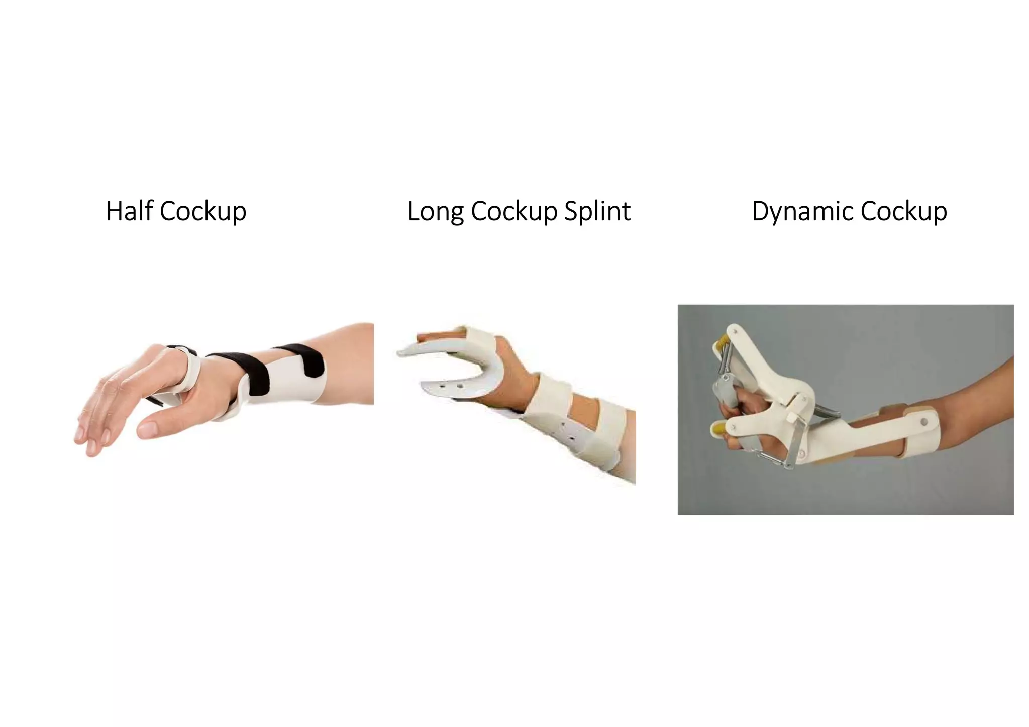 Upper extremity orthoses | PDF