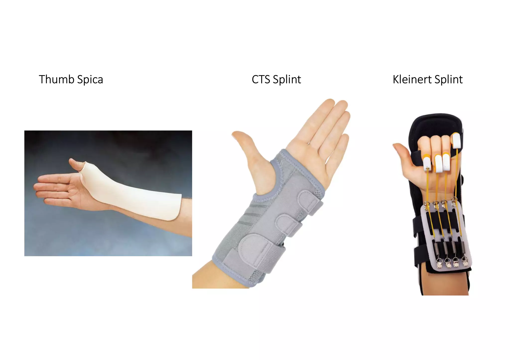 Upper extremity orthoses | PDF