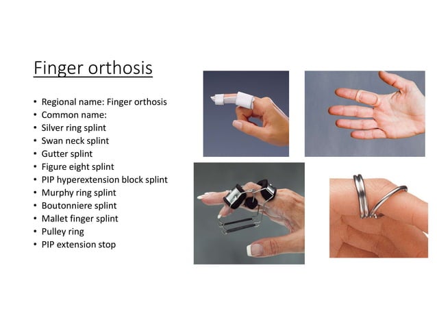 Upper extremity orthoses | PDF