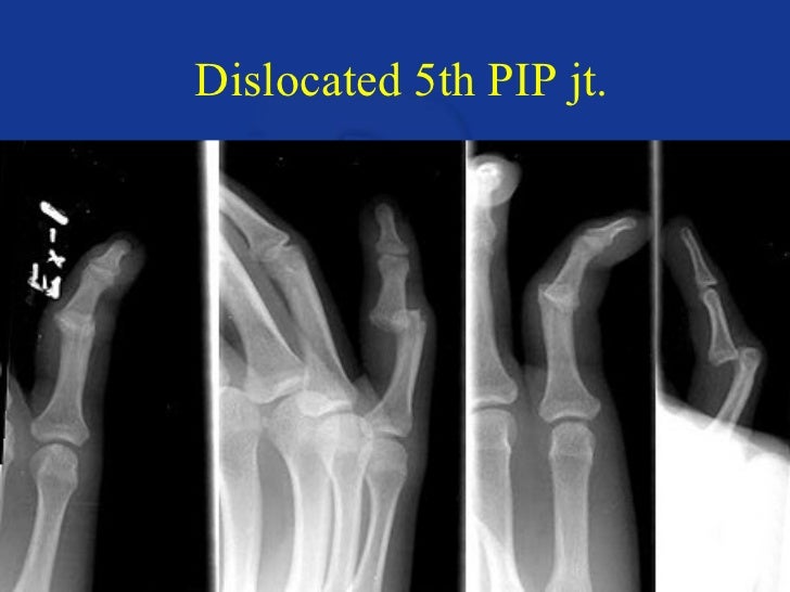 Upper extremity pathology