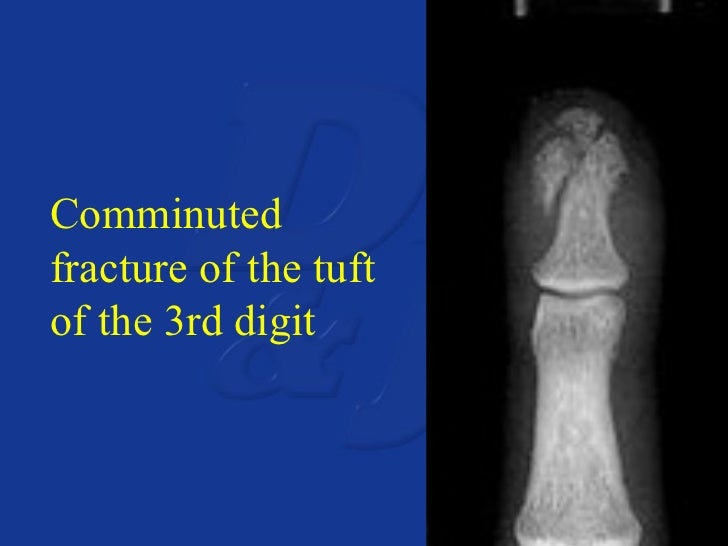What Is Tuft Fracture at Evelyn Lawson blog