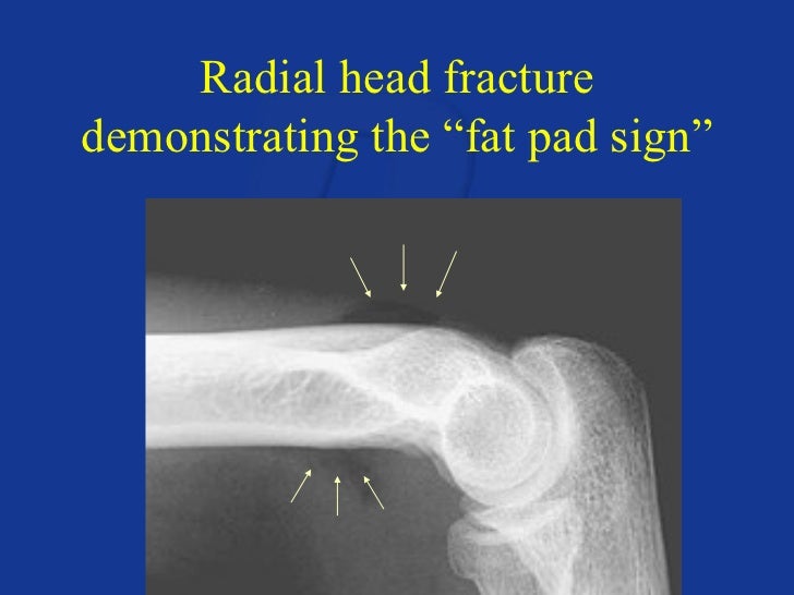 Upper extremity pathology