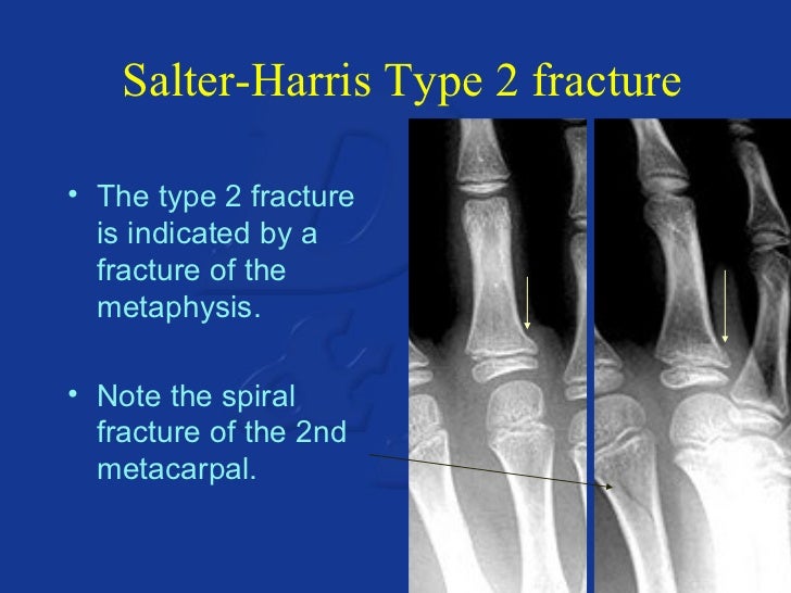 Upper extremity pathology