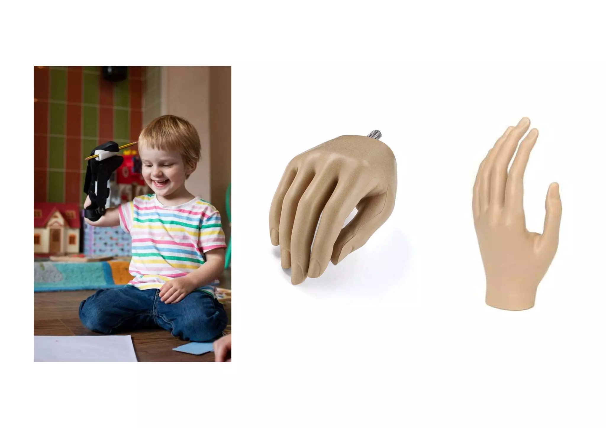 Upper Extremity Prostheses | PDF