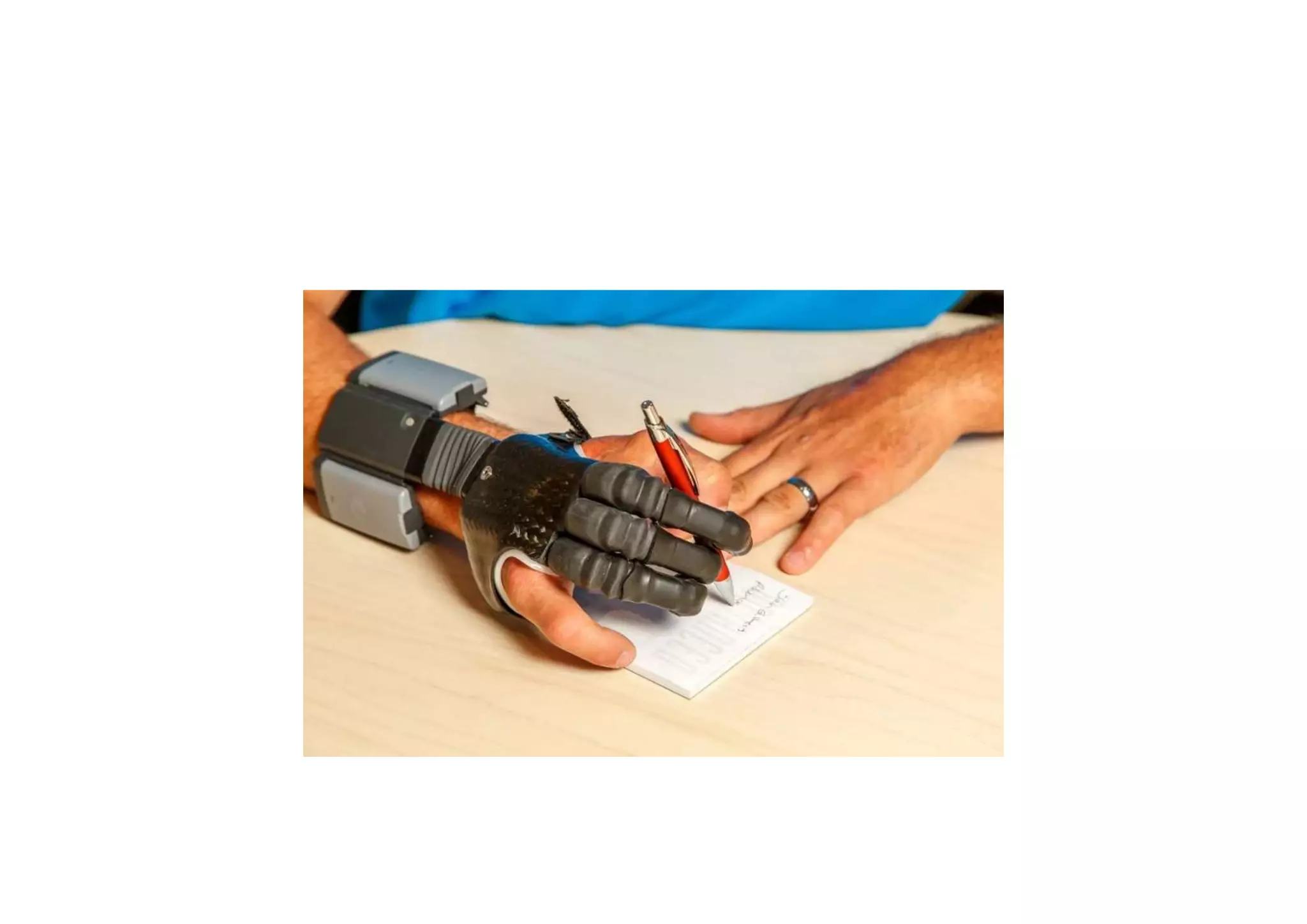 Upper Extremity Prostheses | PDF