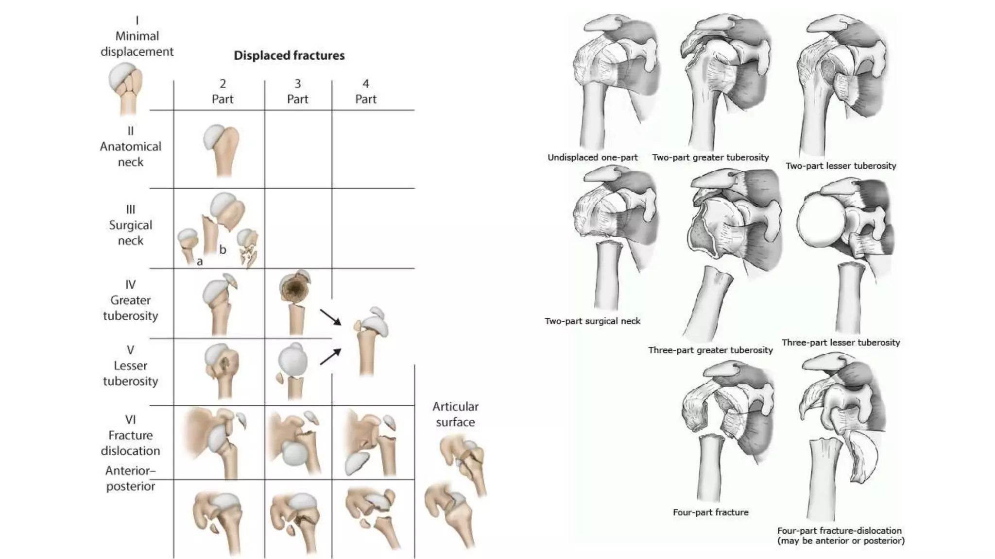 Upper extremity (shoulder fracture | PPTX