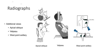 Upper extremity (shoulder fracture | PPTX | Death, Injury, or Military ...