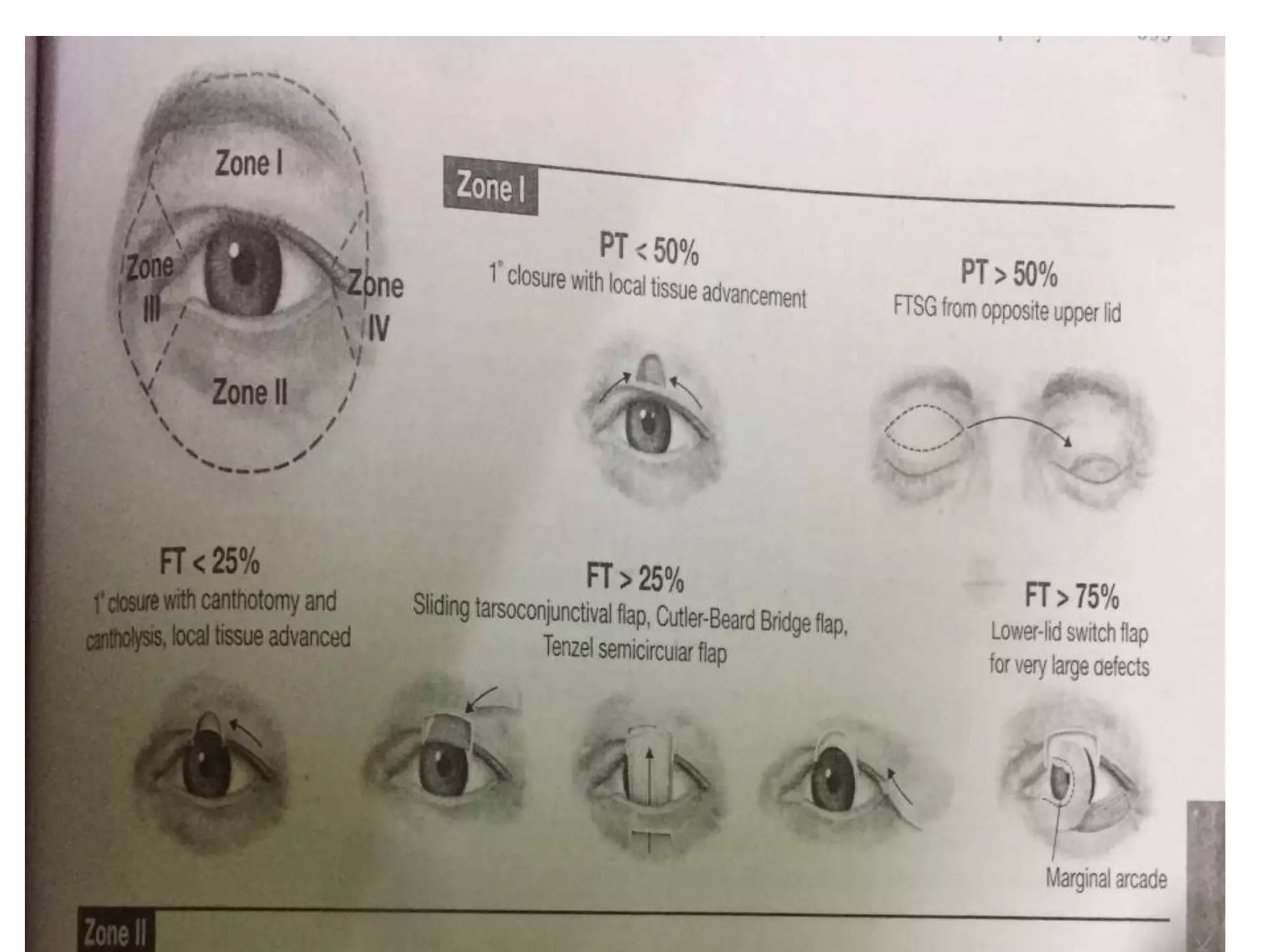 Upper eyelid reconstruction | PPTX