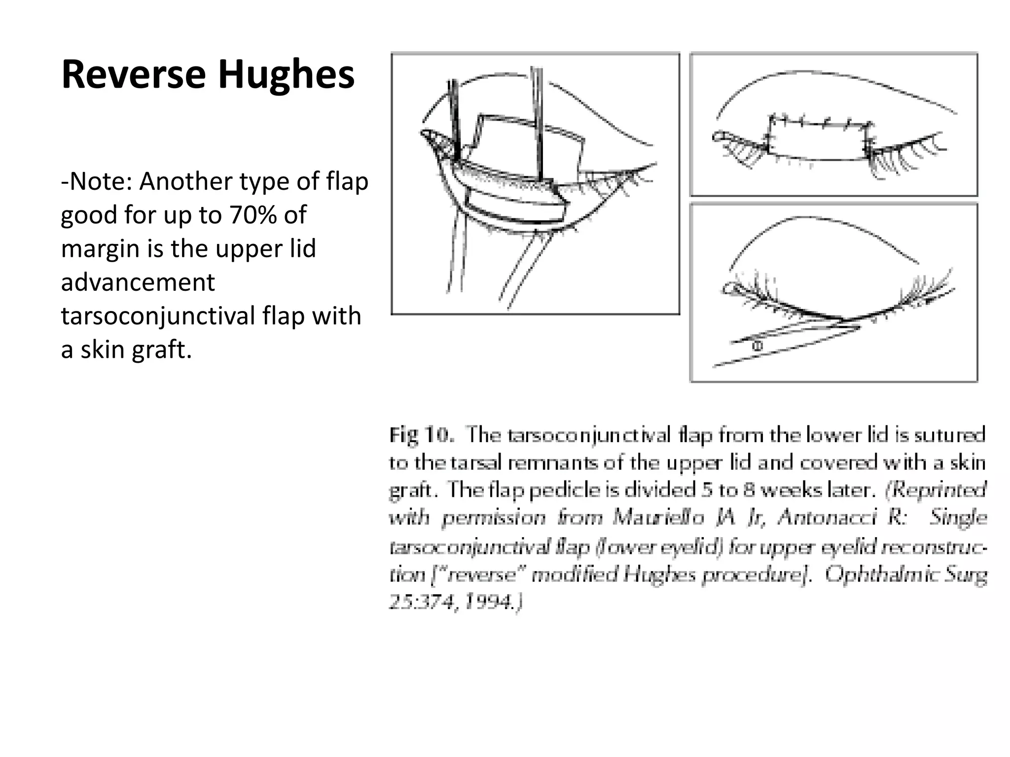 Upper eyelid reconstruction | PPTX