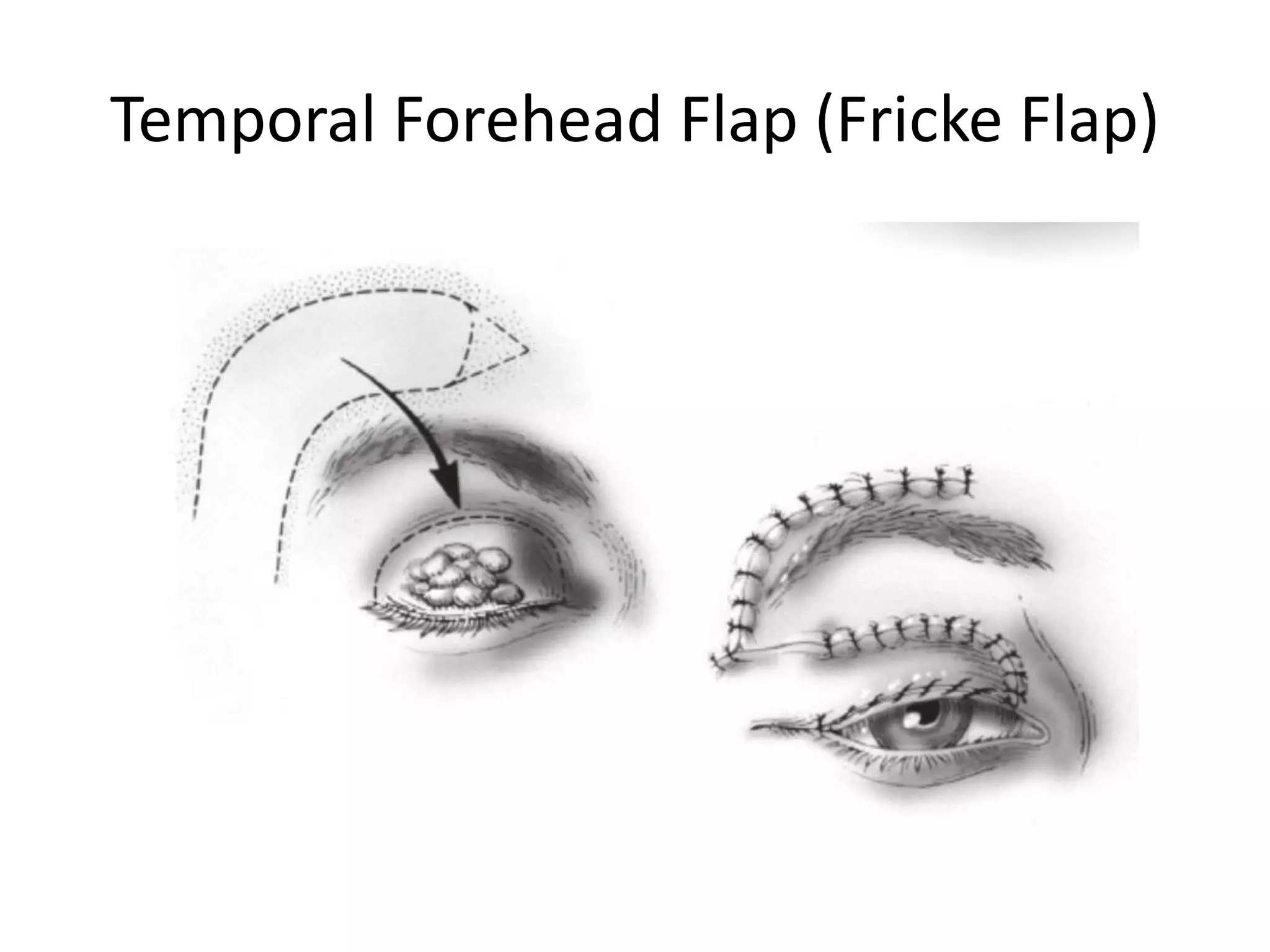 Upper eyelid reconstruction | PPTX