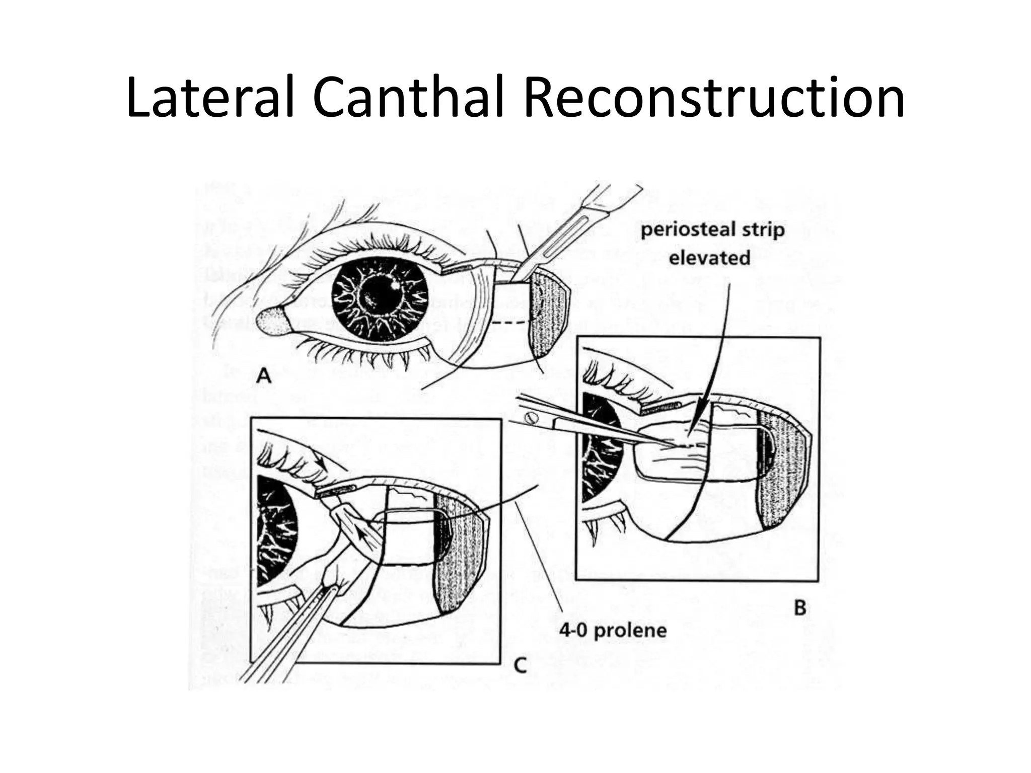 Upper eyelid reconstruction | PPTX