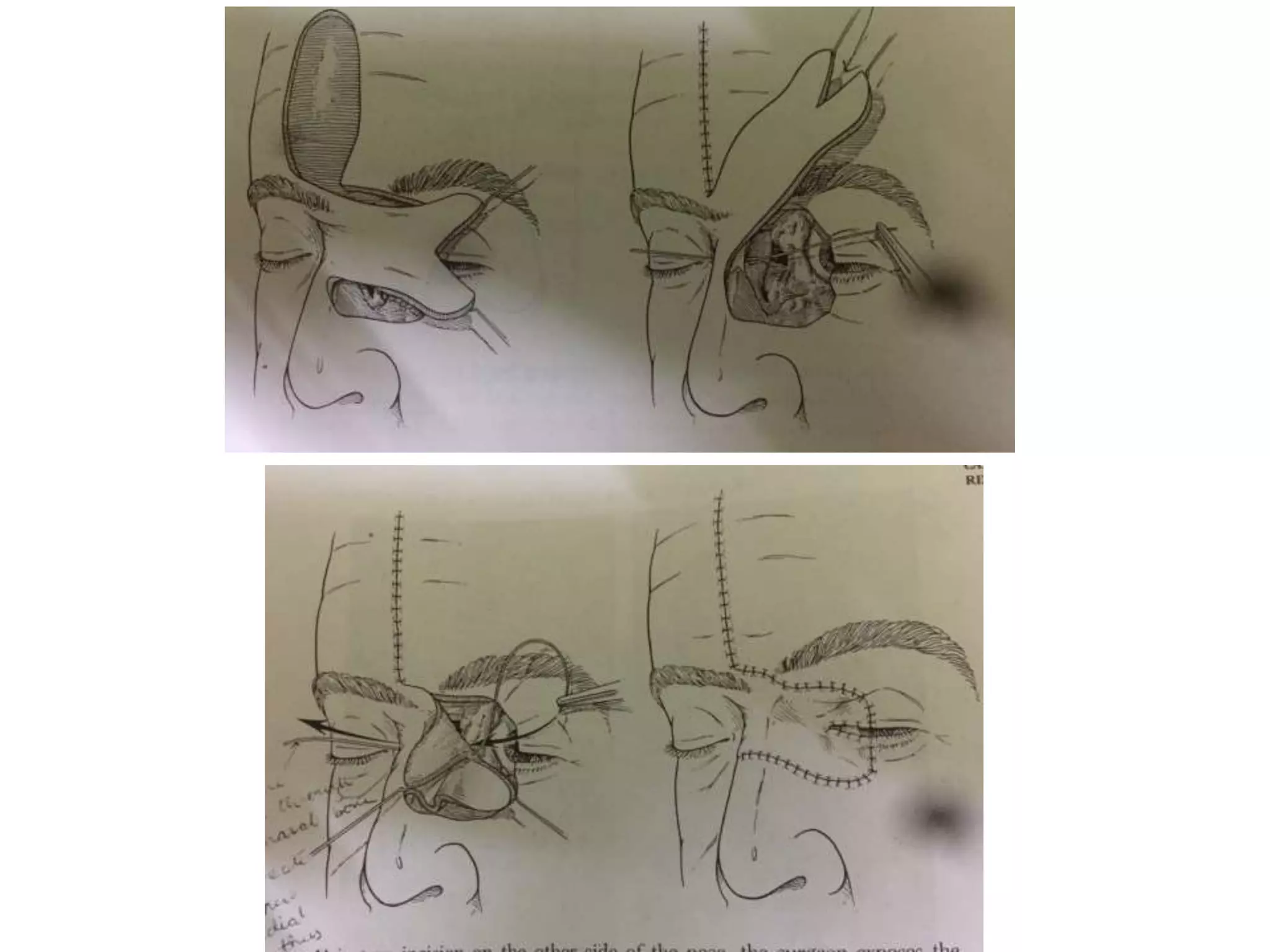 Upper eyelid reconstruction | PPTX