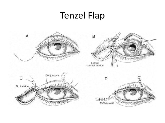 Upper eyelid reconstruction | PPTX