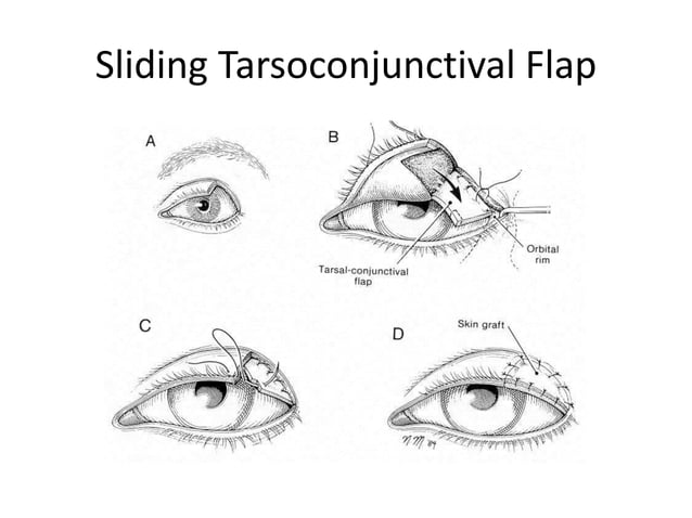 Upper eyelid reconstruction | PPT | Free Download