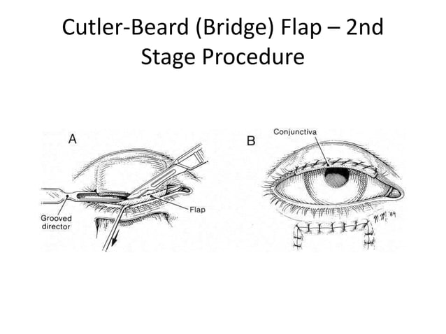 Upper eyelid reconstruction | PPTX