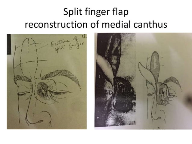 Upper eyelid reconstruction | PPTX